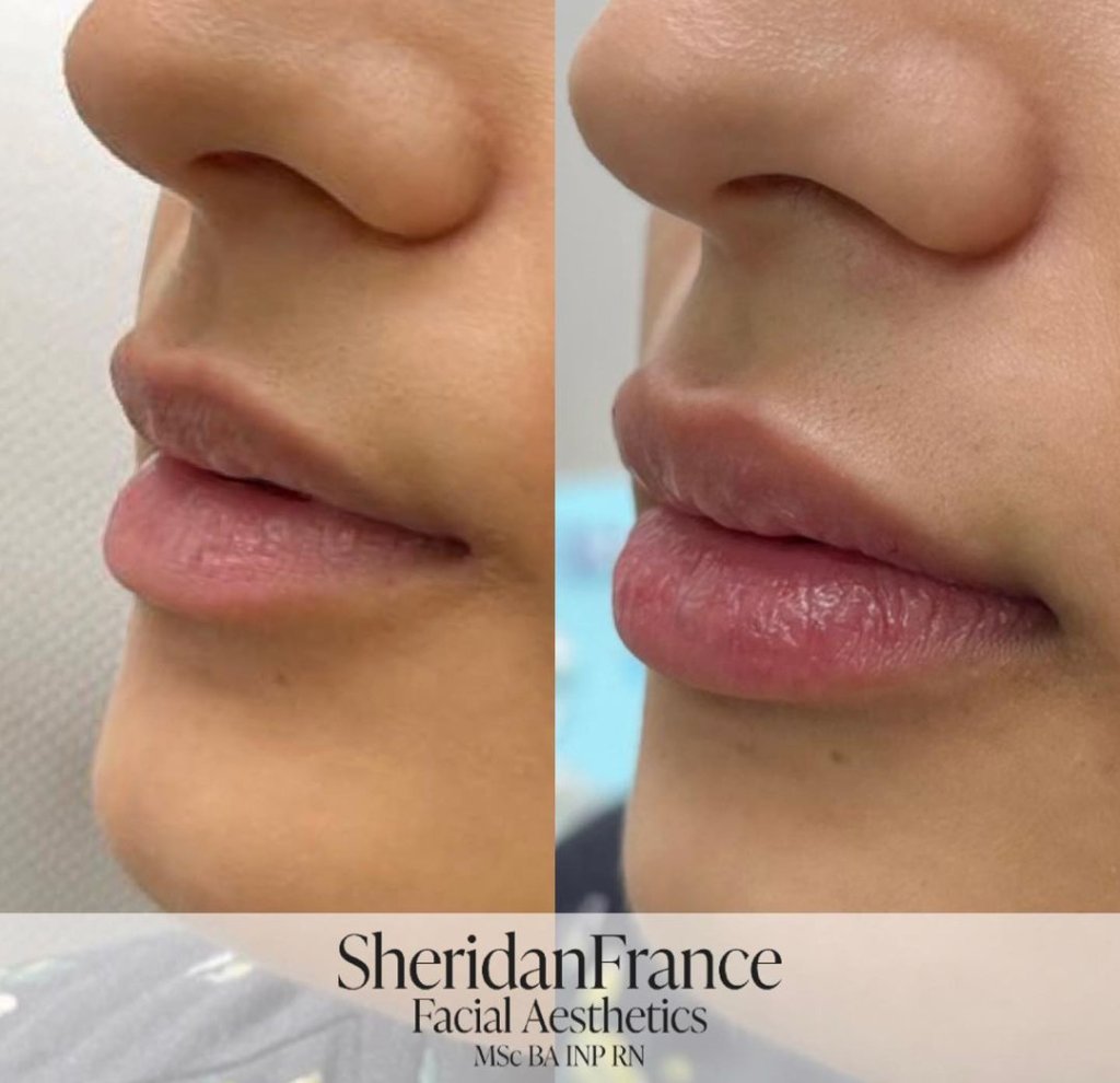 Smile! 7 Best Lip Fillers in London: Clinics and Prices